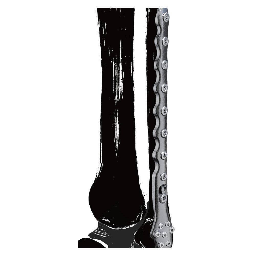 Foot & Ankle Locking System - KK TECH INC.